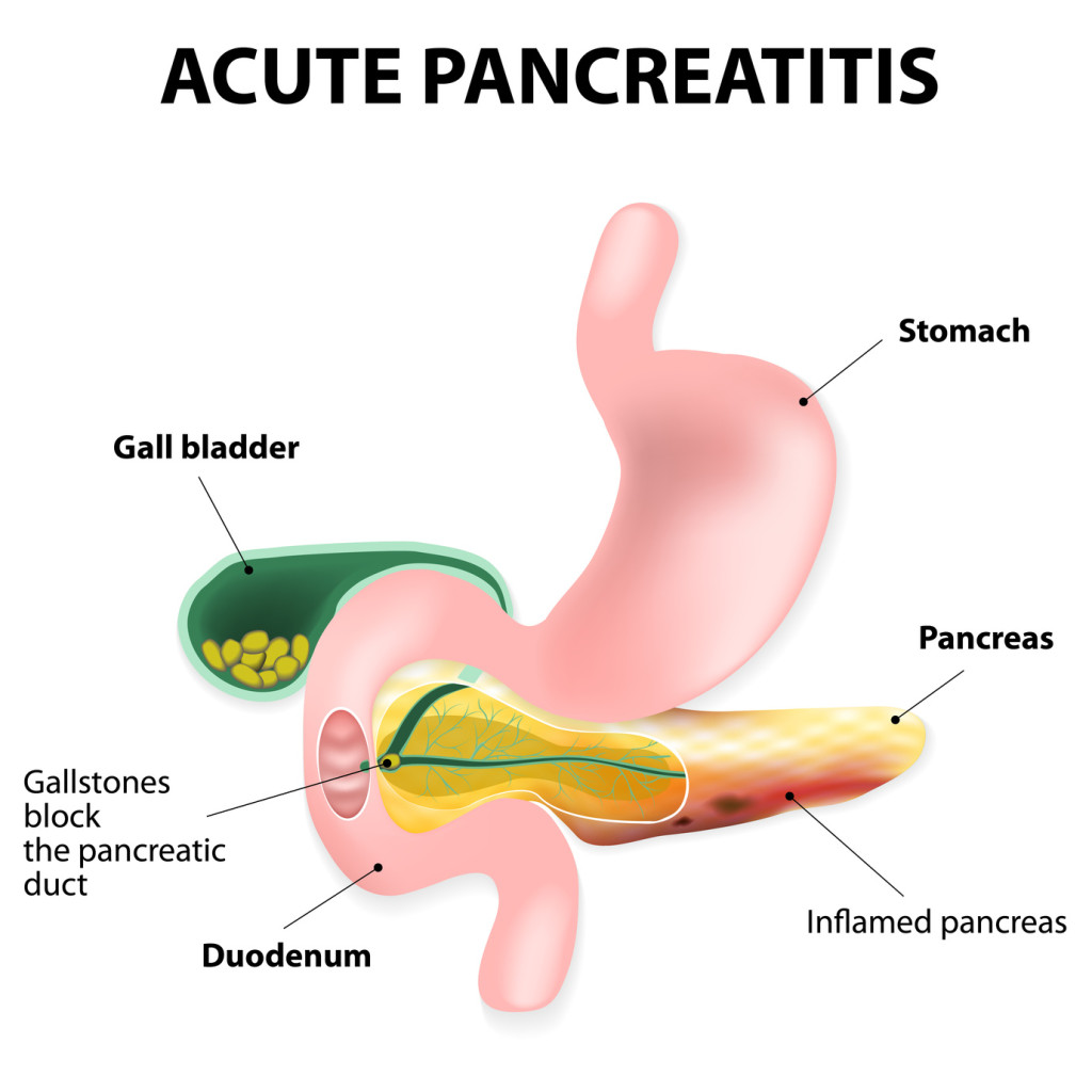 Acute pancreatitis - Foodicine Health, Inc
